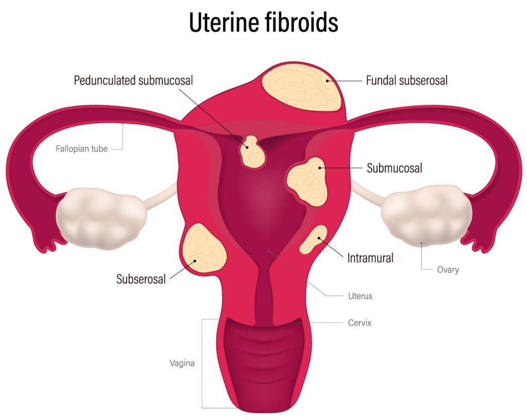 Fibro – fertilitycu.com